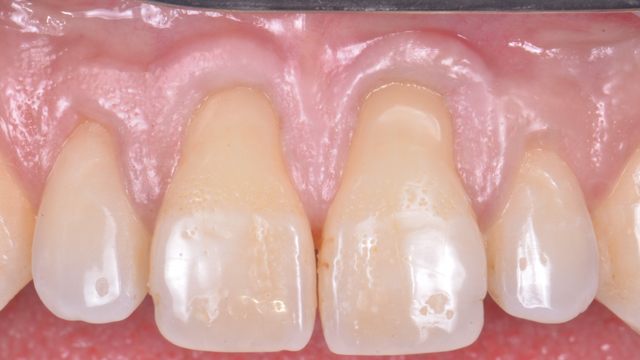 Trattamento chirurgico di recessioni gengivali RT-1 su incisivi ...